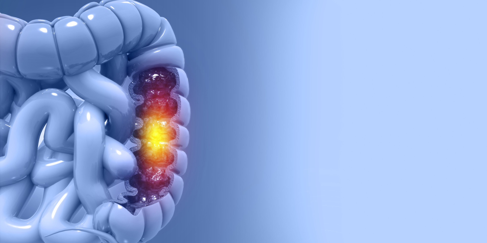 The silent signs of colorectal cancer