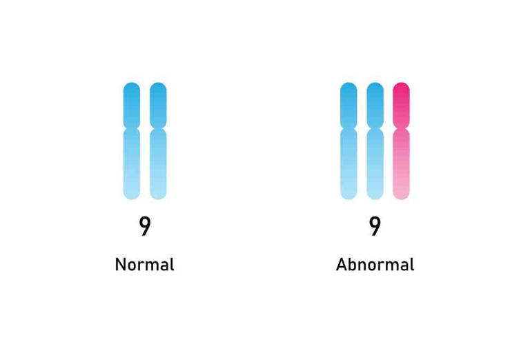 Trisomy 13 Syndrome: Causes, Symptoms, Diagnosis and Treatment