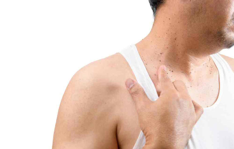 Moles, Freckles, and Skin Tags: Meaning, Causes and Treatment