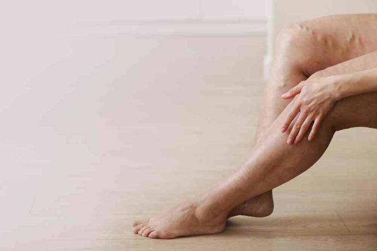 Edema: Types, Causes, Symptoms and Treatment