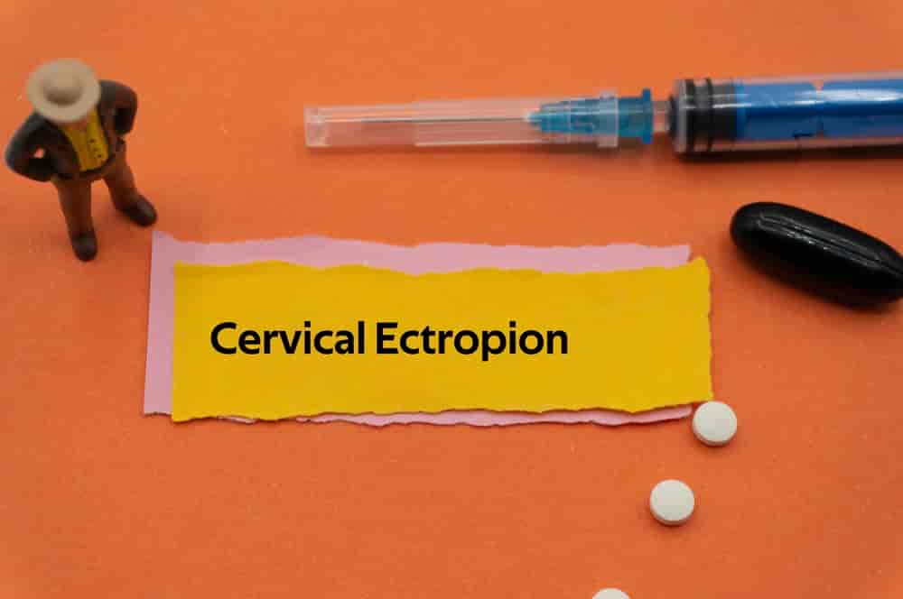 Cervical Ectropion: Risks, Symptoms, Diagnosis, and Treatment