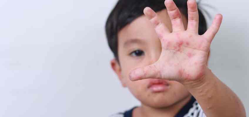 Gianotti-Crosti Syndrome: Meaning, Symptoms and Treatment