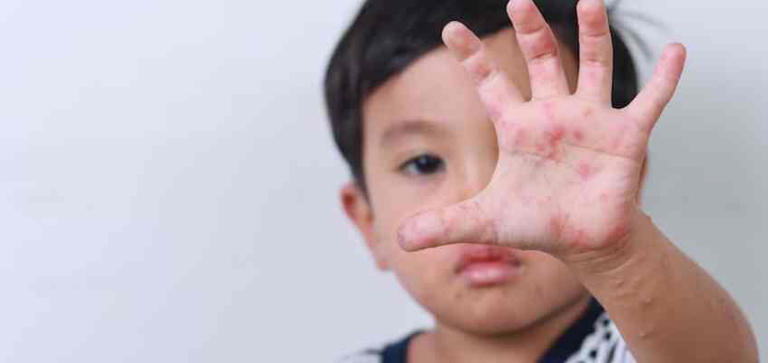 Gianotti-Crosti Syndrome: Meaning, Symptoms and Treatment