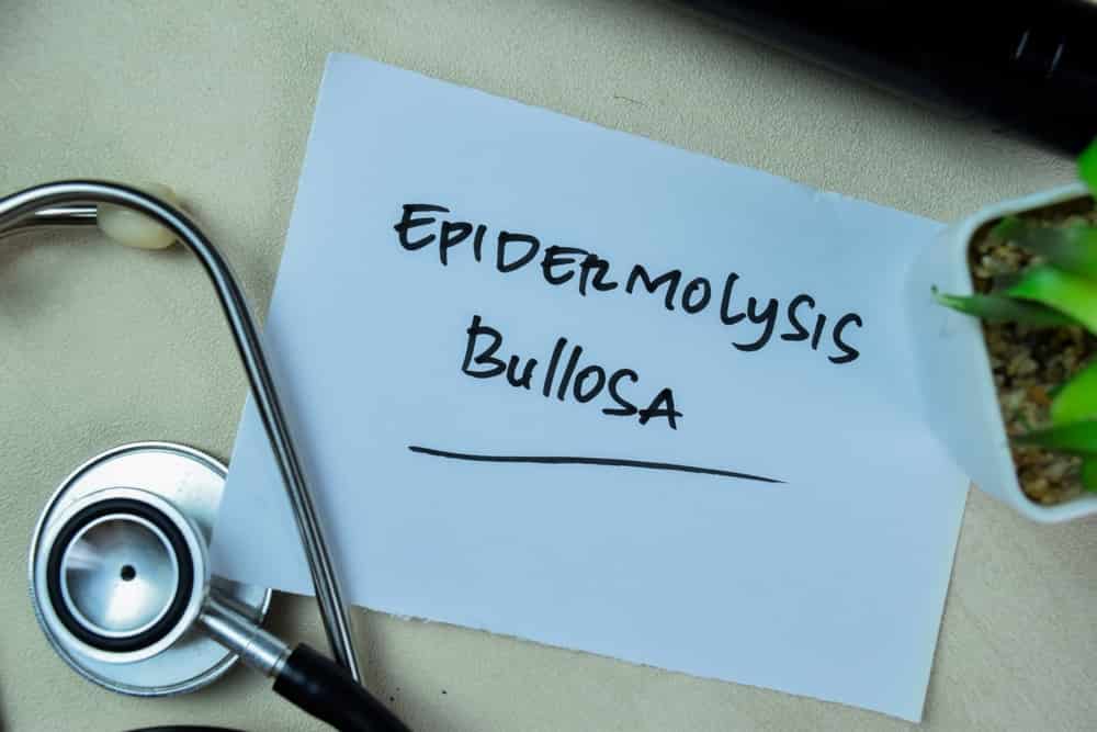 Epidermolysis Bullosa: Types, Causes, Symptoms and Treatments