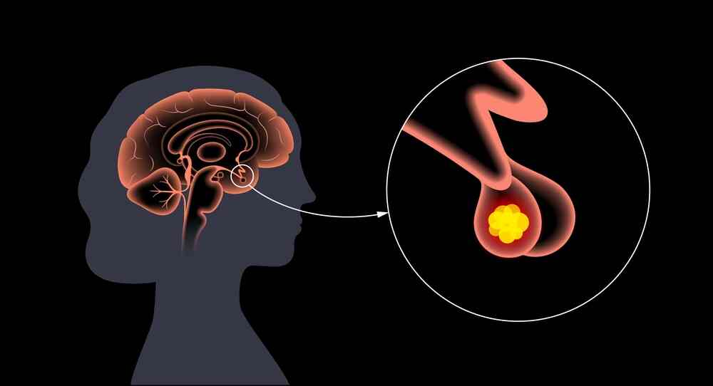 Empty Sella Syndrome: Symptoms and Treatment