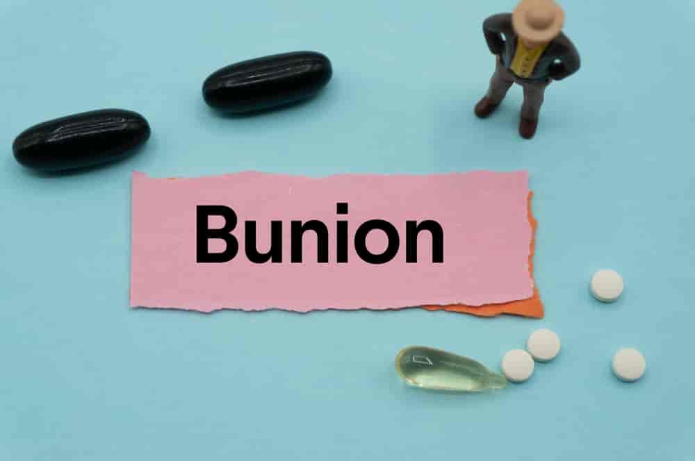 Bunions: Symptoms, Causes, Diagnosis, and Treatment