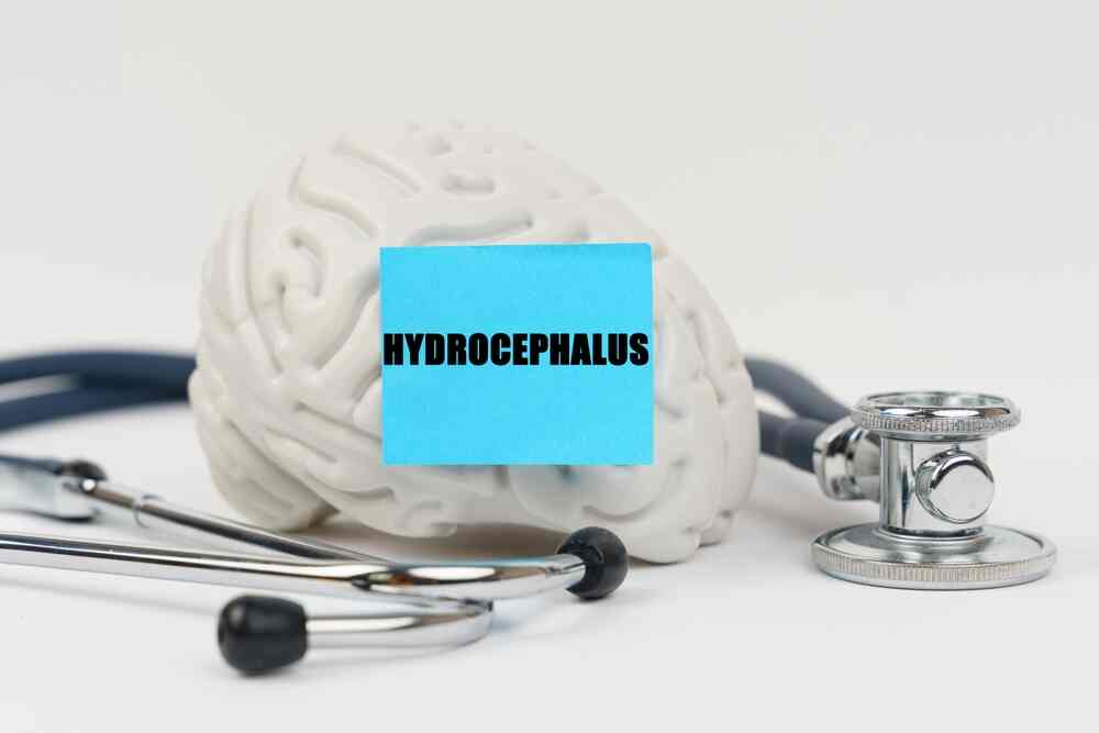 Hydrocephalus: Symptoms, Causes, Types, Diagnosis, Treatment, and ...