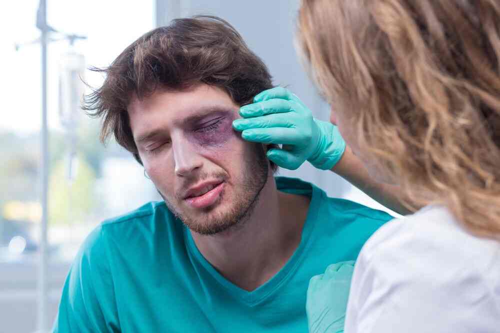 Black Eye: Symptoms, Causes, Treatments and Prevention