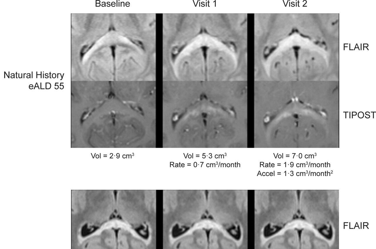 Oral drug shows promise for slowing fatal childhood brain disease