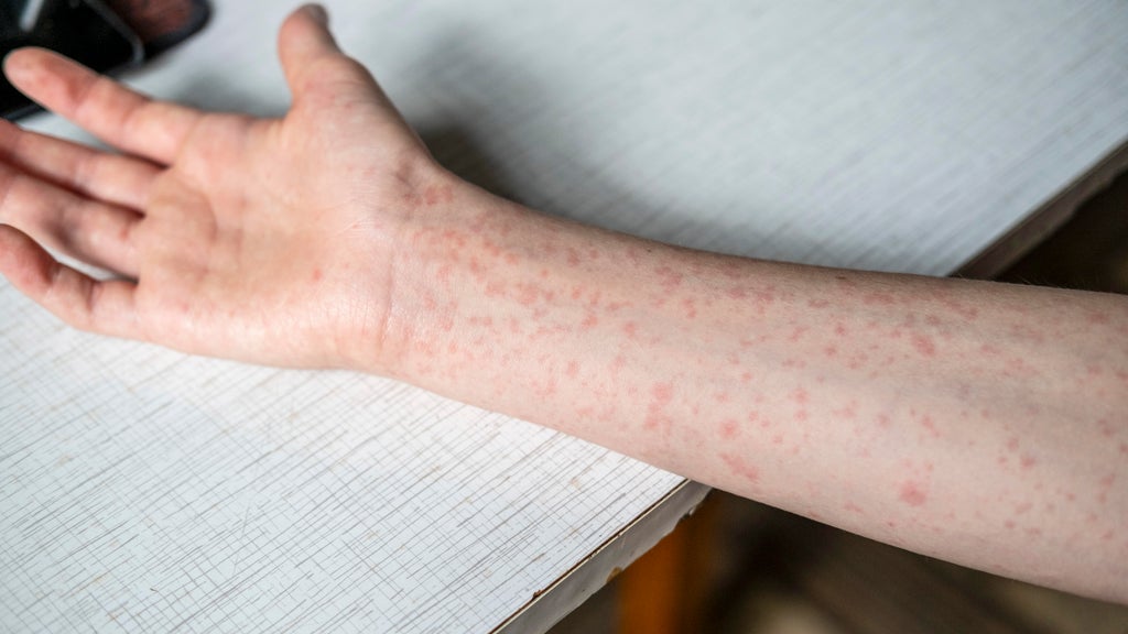 2 more measles cases confirmed in Minnesota as 2025 total climbs to 4 ...