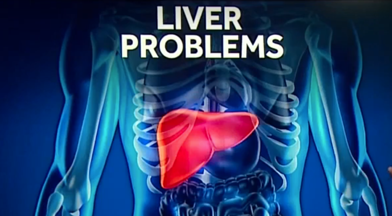 How to recognize signs of nonalcoholic liver disease