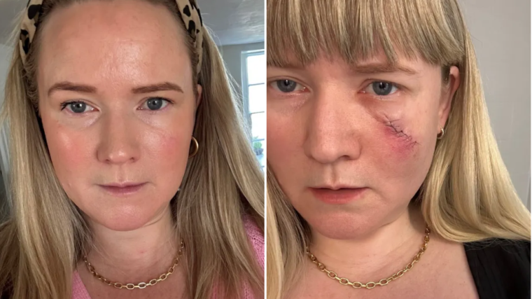 I ignored the signs of skin cancer for years – please don’t make my mistake