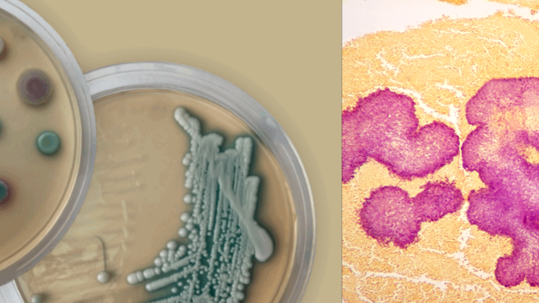 Know All About The Candidozyma Auris, The Fungal Pathogen And A Rising ...