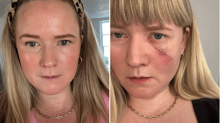 I ignored the signs of skin cancer for years – please don’t make my mistake