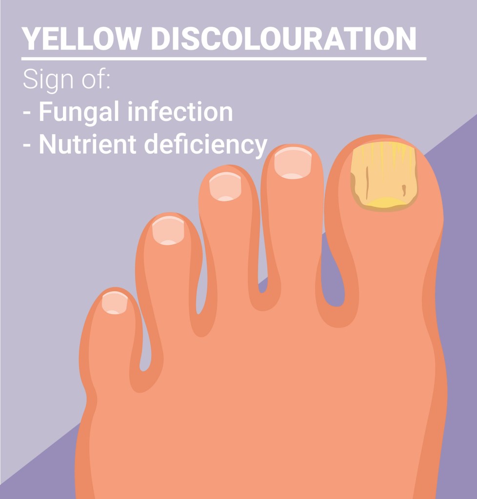 What your toes say about your health — 8 warning signs to look out for
