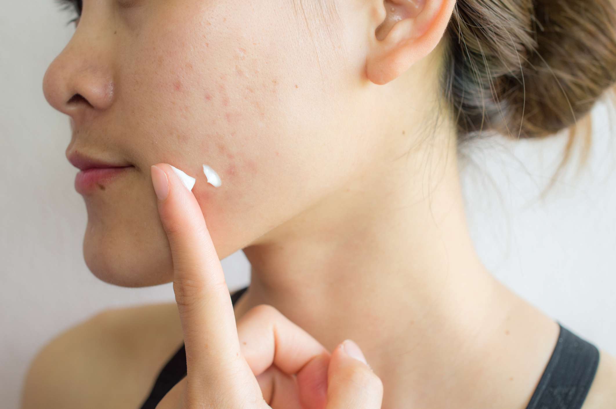 Putting Toothpaste on Pimples: Does It Actually Work for Acne?