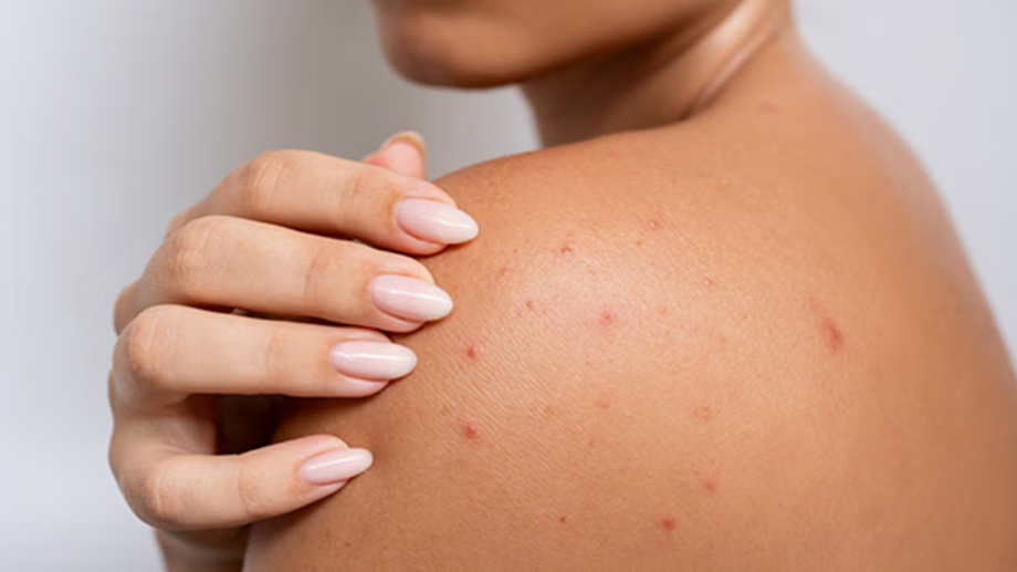 Summer Tips: If you are getting heat rash on your shoulders due to ...