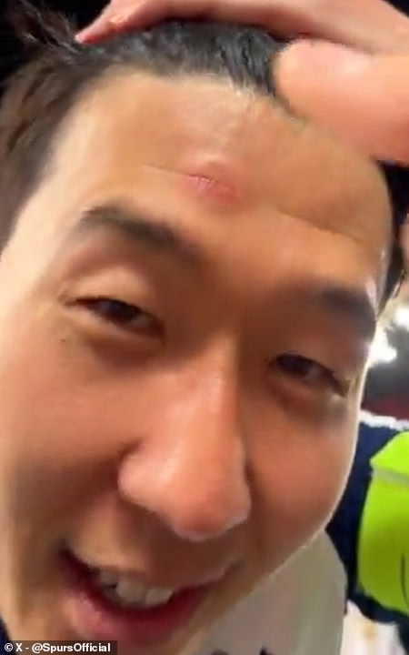 Tottenham captain Son Heung-min left with battle scar following freak ...