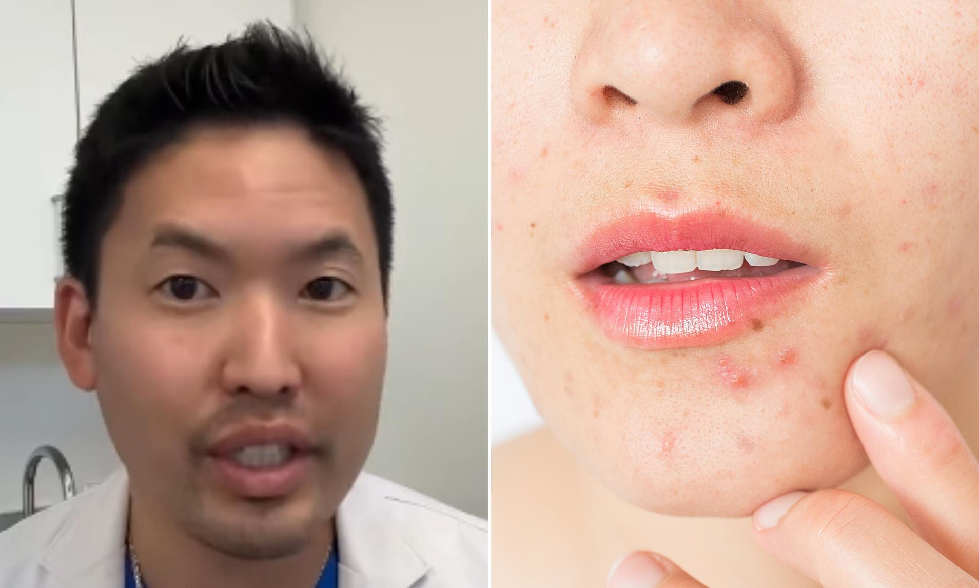 Dermatologist reveals incredibly subtle clue that your tiny pimple is ...