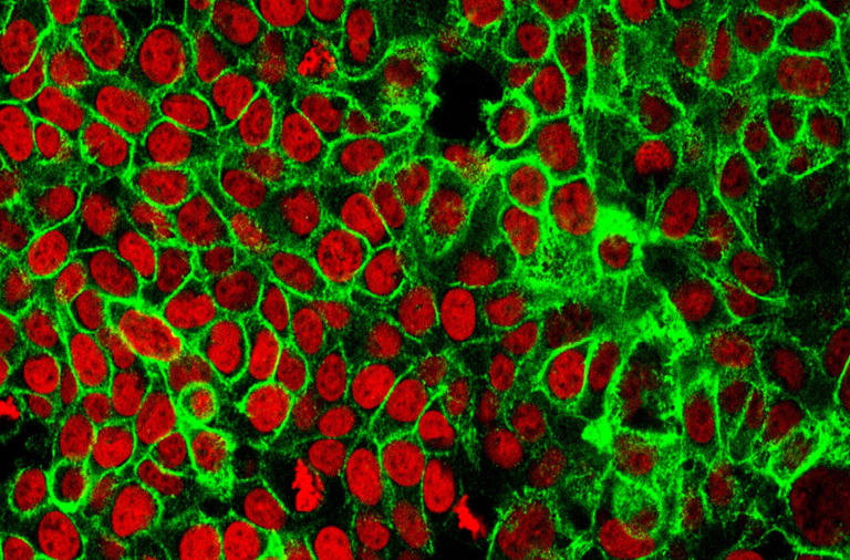 A machine learning tool can help with diagnosing, monitoring colorectal ...