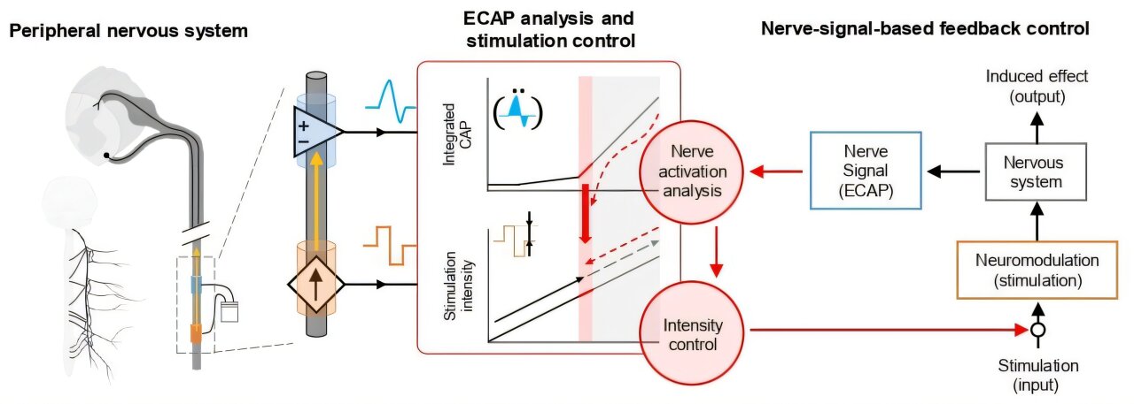 Personalized nerve stimulation shows promise for overactive bladder relief