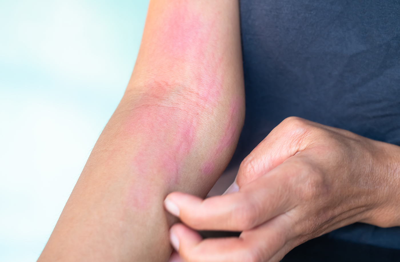 Allergie au soleil : soulager naturellement les symptômes avec les ...