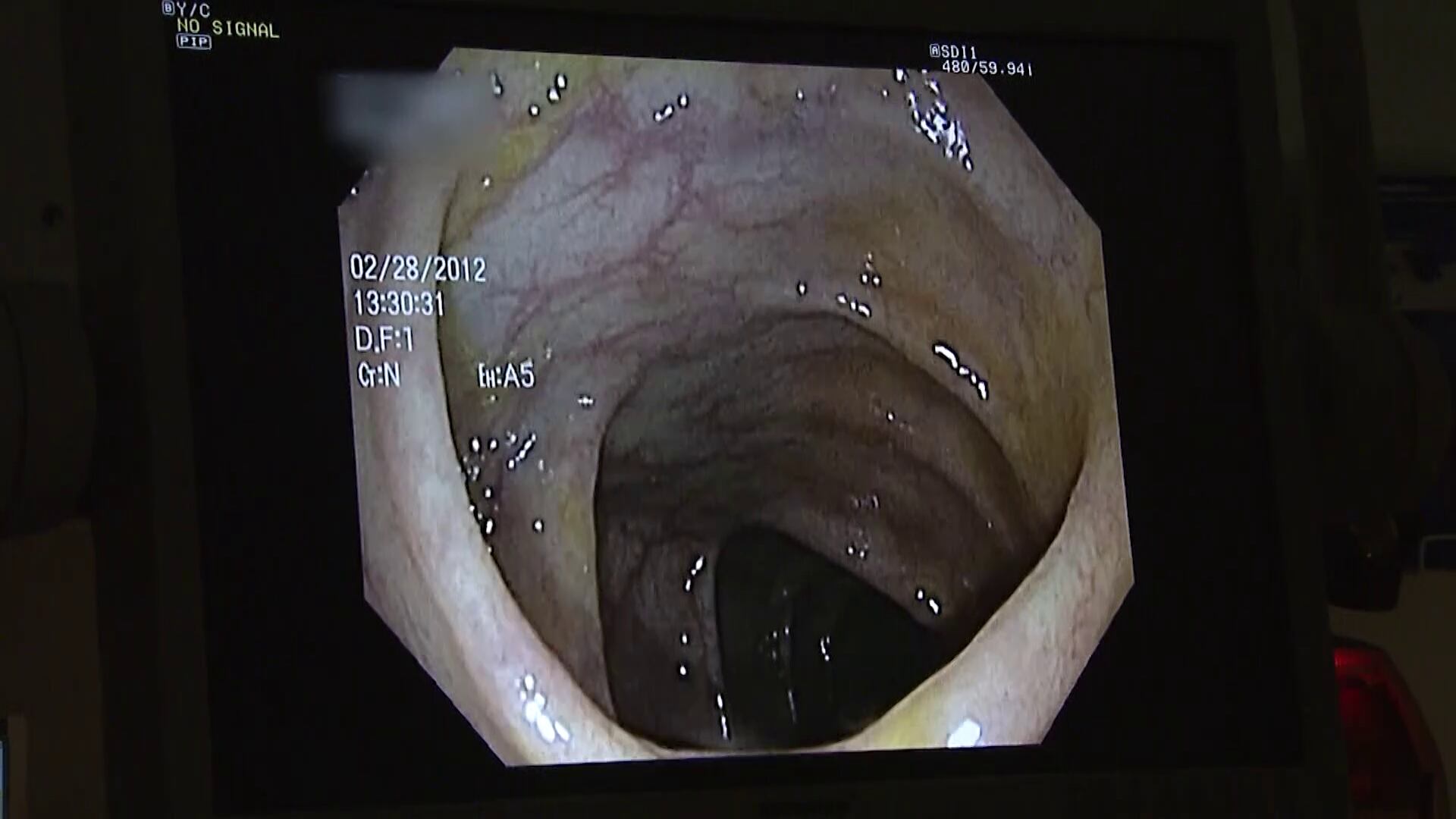 How To Lower Your Risk of Colorectal Cancer