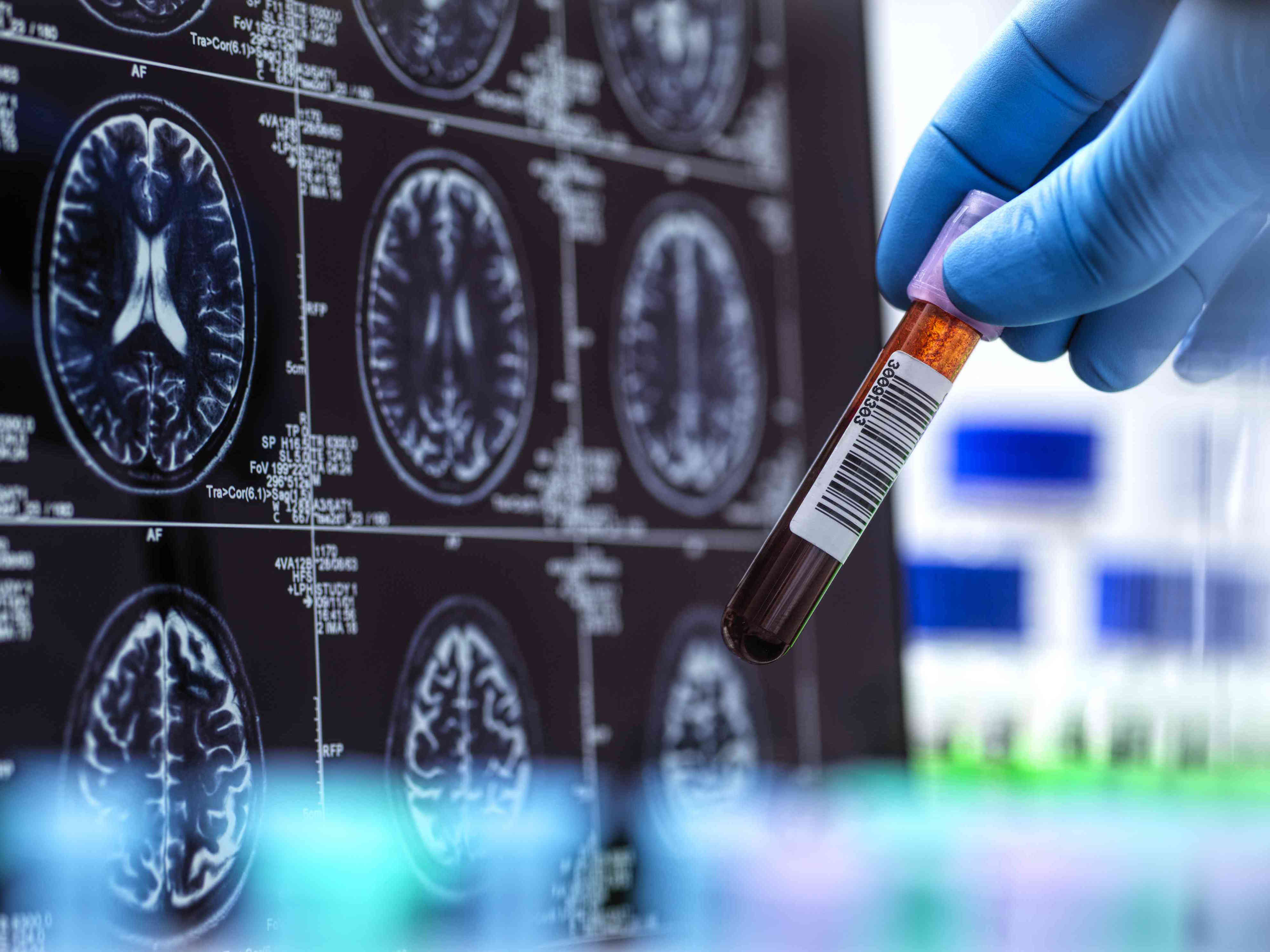 A Simple Blood Test Could Improve Early Alzheimer’s Disease Detection