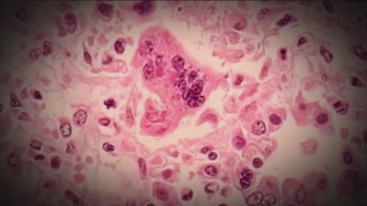 Iowa HHS confirms measles case in central Iowa, the first since 2019