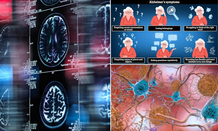 You can spot Alzheimer's YEARS before symptoms appear with groundbreaking scan...would YOU have it?