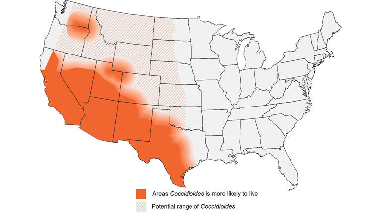 Soil fungus found in at least 12 states can lead to lung infections ...