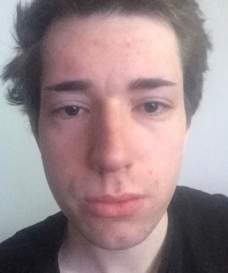 A Man’s Drastic Cat-Eye Surgery and Filler Removal Transformation ...