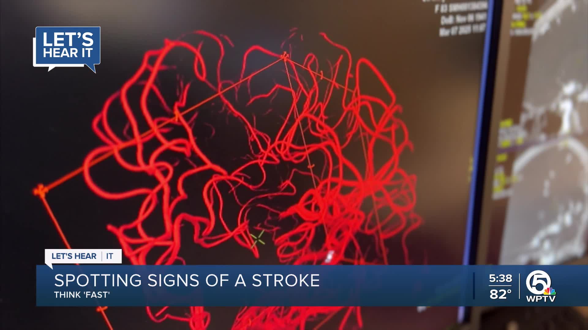 Signs of a stroke: Think FAST