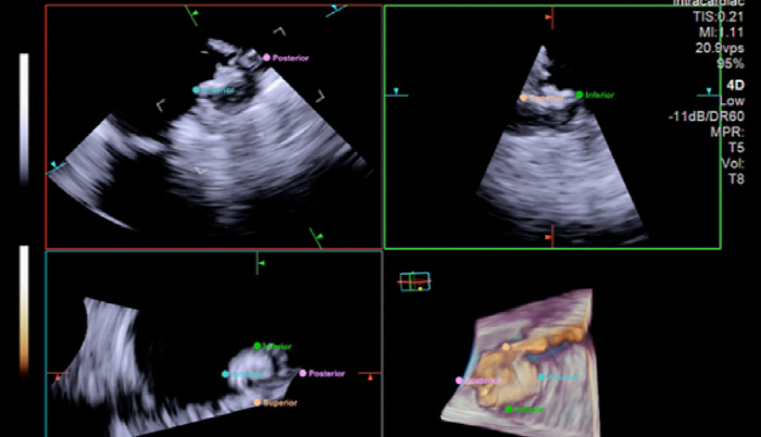 Boramae Hospital succeeded in obstructing the left atrial appendage ...