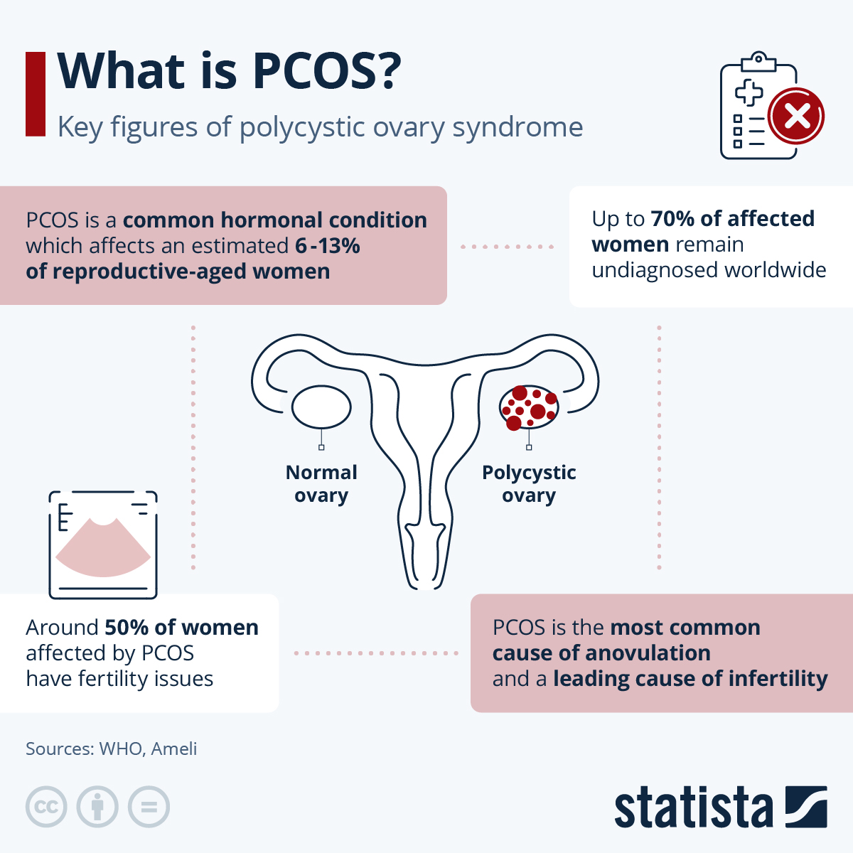 What is PCOS?