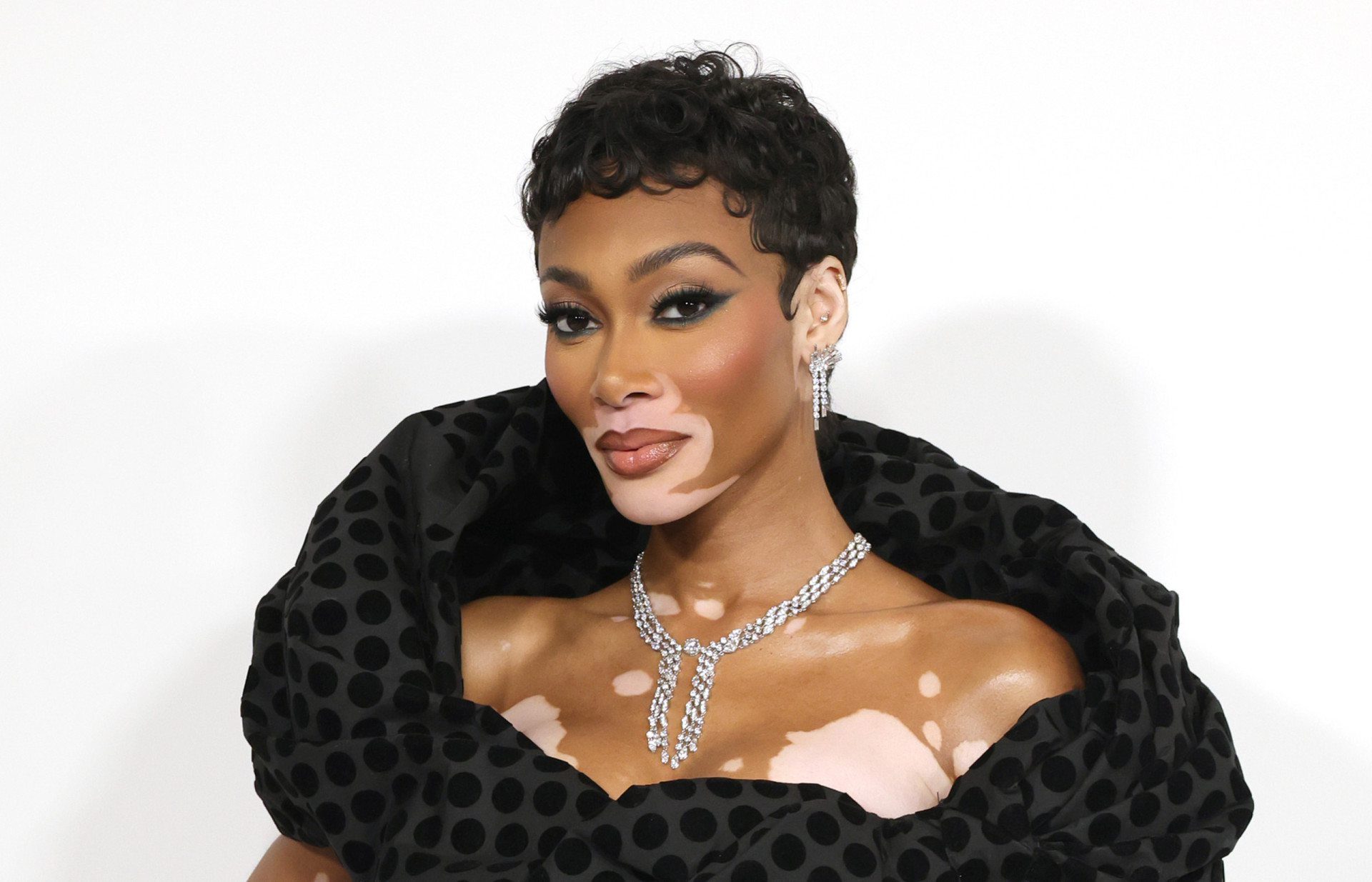 Celebrities who have vitiligo