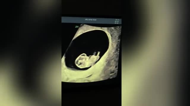 Adorable moment Sophie Habboo and Jamie Laing hear unborn baby’s ...