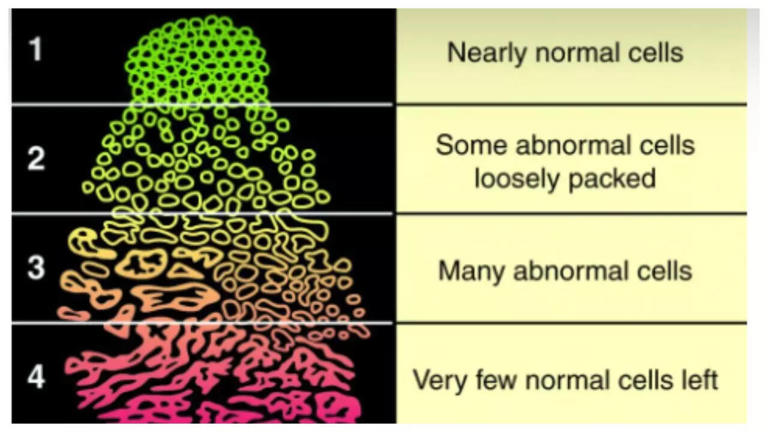 What is the Gleason score in prostate Cancer and why early testing is ...