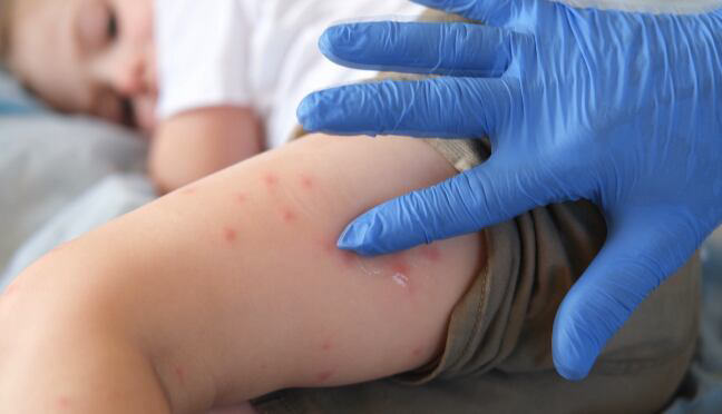 First case of measles confirmed in Bell County, Texas First case of measles confirmed in Bell County, Texas