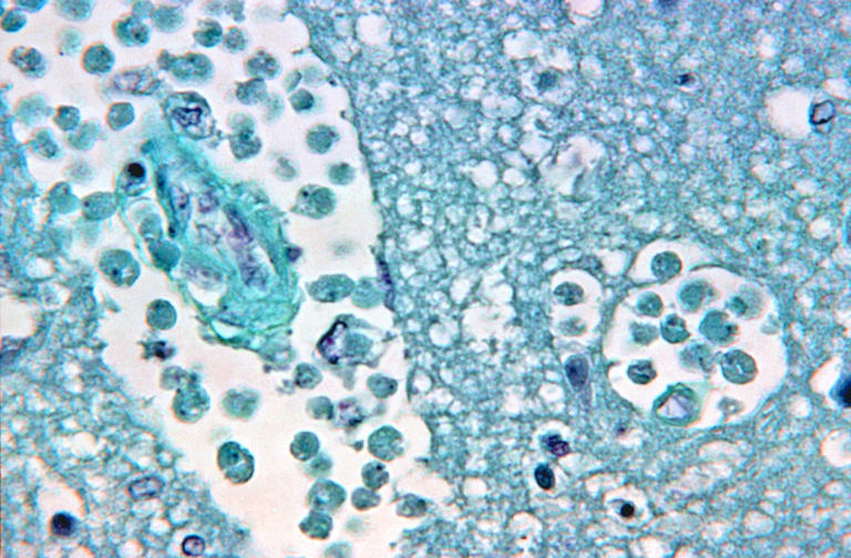 What is naegleria fowleri, and can the brain-eating amoeba kill you?