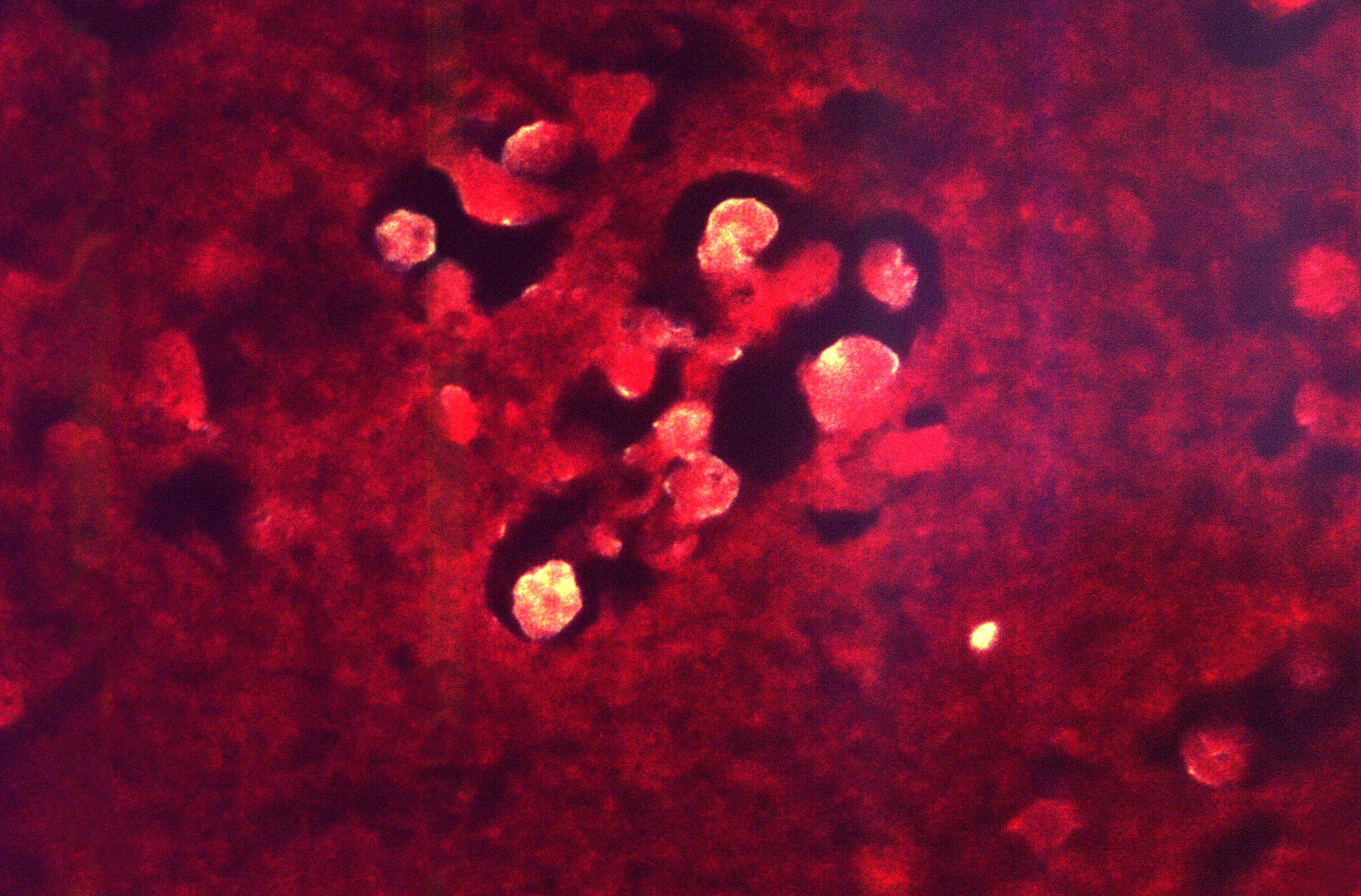 Person dies from brain-eating amoeba in South Carolina, officials say