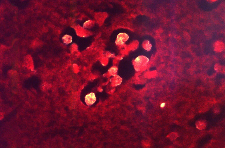 Texas woman dies from brain-eating amoeba after clearing sinuses with ...