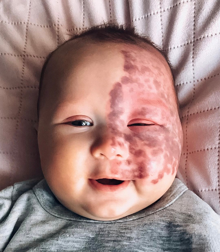 Une maman, traitée de “monstre” pour avoir fait enlever la tache de ...