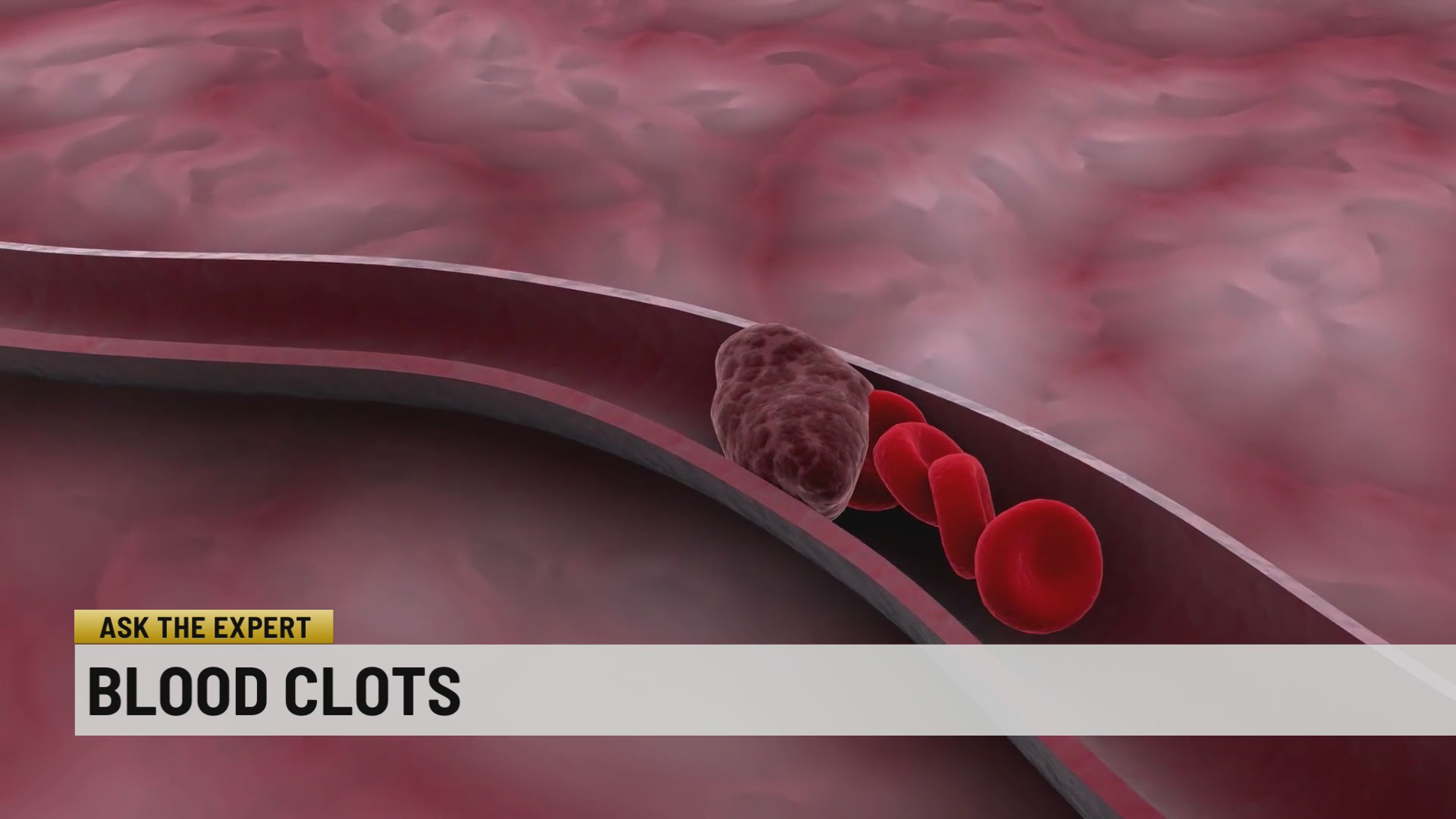 Ask the Expert: The Warning Signs of Blood Clots