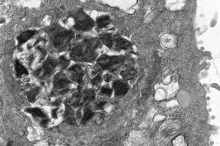 Critical step in COVID-19 infection identified—how the virus shields ...