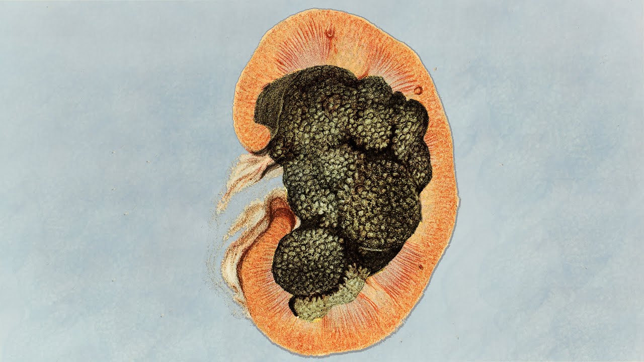 What happens to your kidneys if you squat 50 reps in 20 minutes