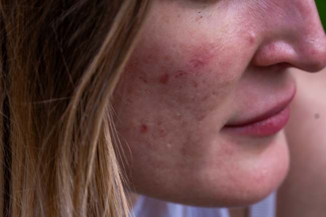 Finally! FDA Approves a New Type of Treatment for Pimples & Bumps of ...
