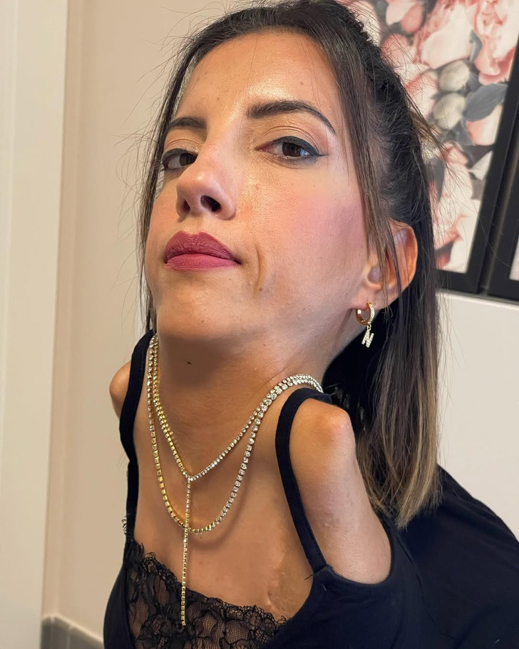 Meet a Woman Who Was Born Without Arms and a Leg. Now She’s Changing ...