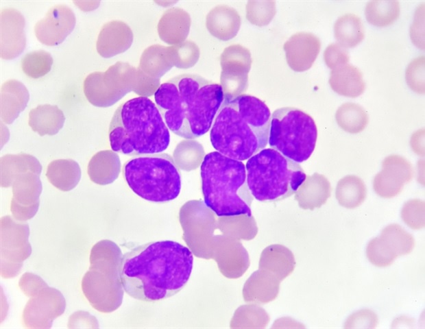 A new generation of AML treatments brings hope for better survival