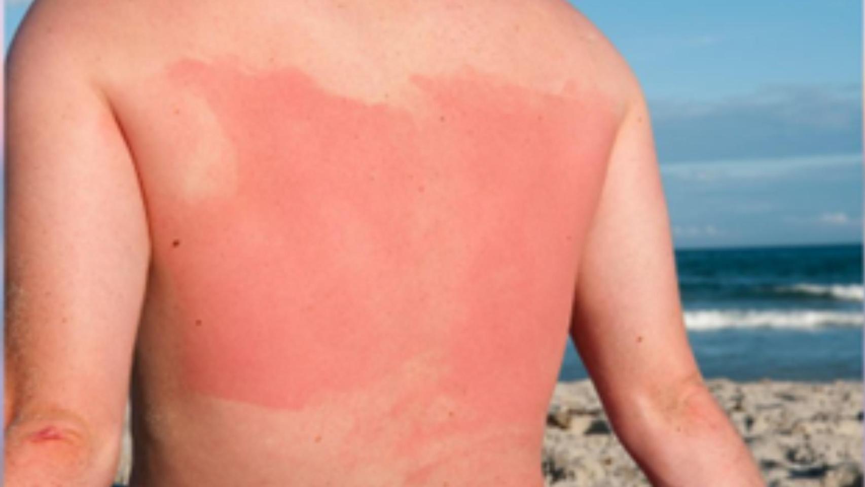 ¿Puedo tomar el sol con esta medicación?